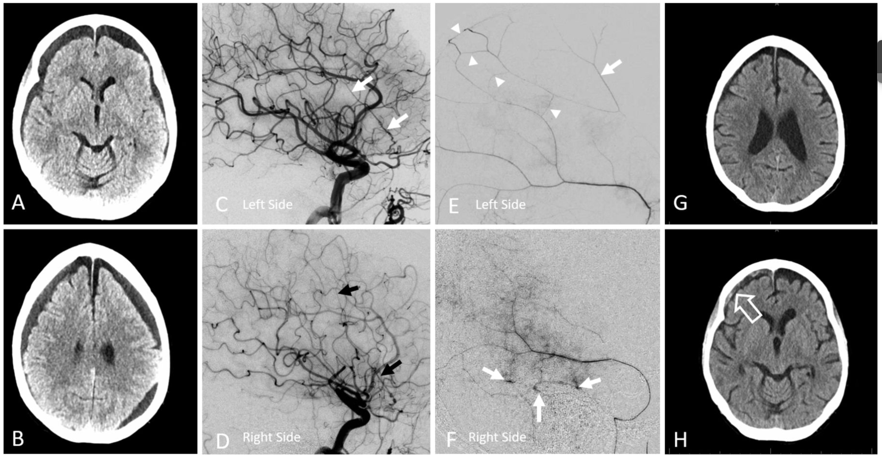 Mma Embolization Bilateral Recurrent Meningeal Arteries